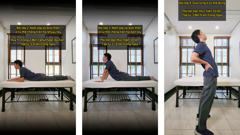 Bài tập McKenzie cho người lồi, thoát vị đĩa đệm, đau lưng và đau thần kinh toạ